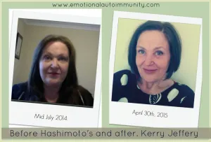 Before and after Hashimoto’s